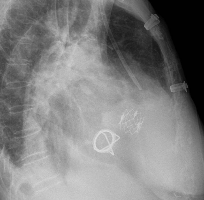 Kardiologie - Herzklappenprothesen im Röntgenbild